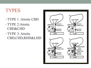 Congenital anamolies and applied anatomy of biliary tree | PPTX