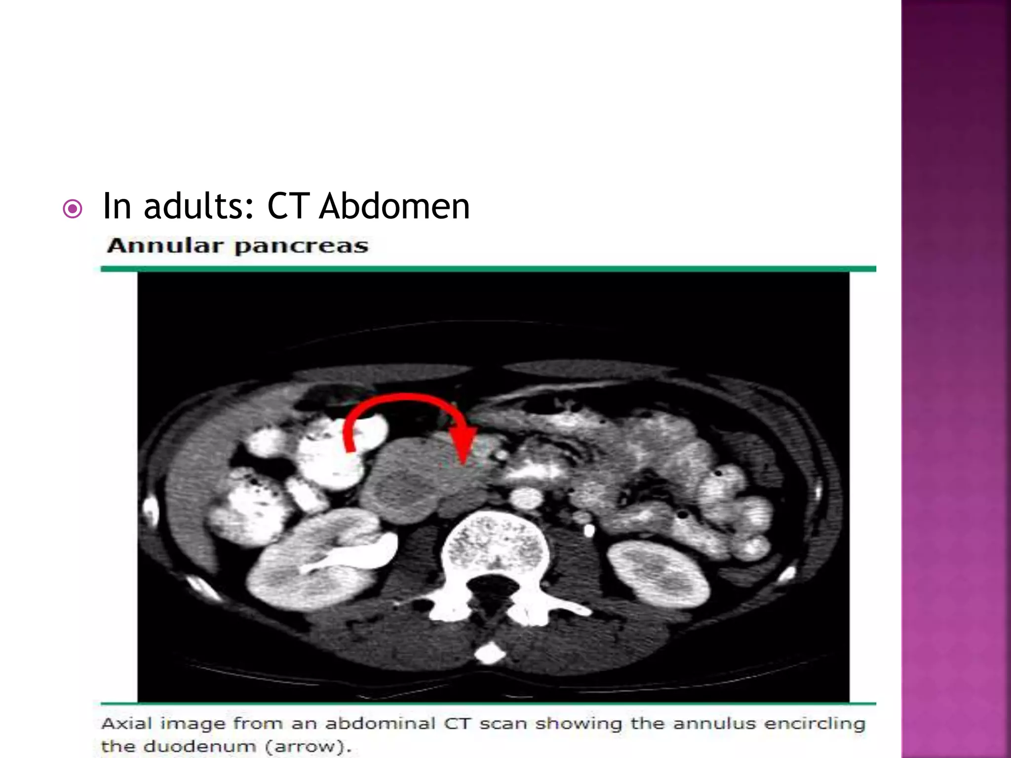 Congenital anamolies of pancrease | PPTX