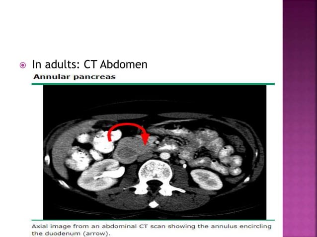 Congenital anamolies of pancrease | PPTX | Digestive Disorders | Diseases and Conditions