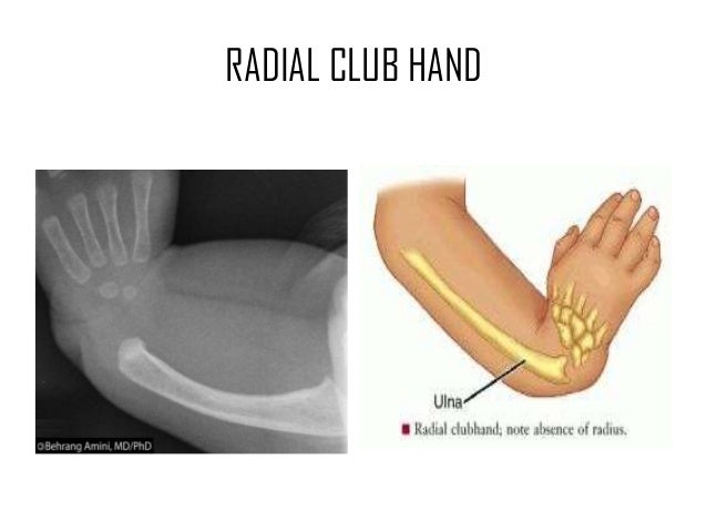 Congenital anamolies upper limb - Dr.KK