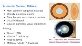 CONGENITAL AND DEVELOPMENTAL CATARACT-1.pptx