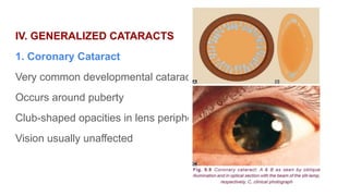 CONGENITAL AND DEVELOPMENTAL CATARACT-1.pptx