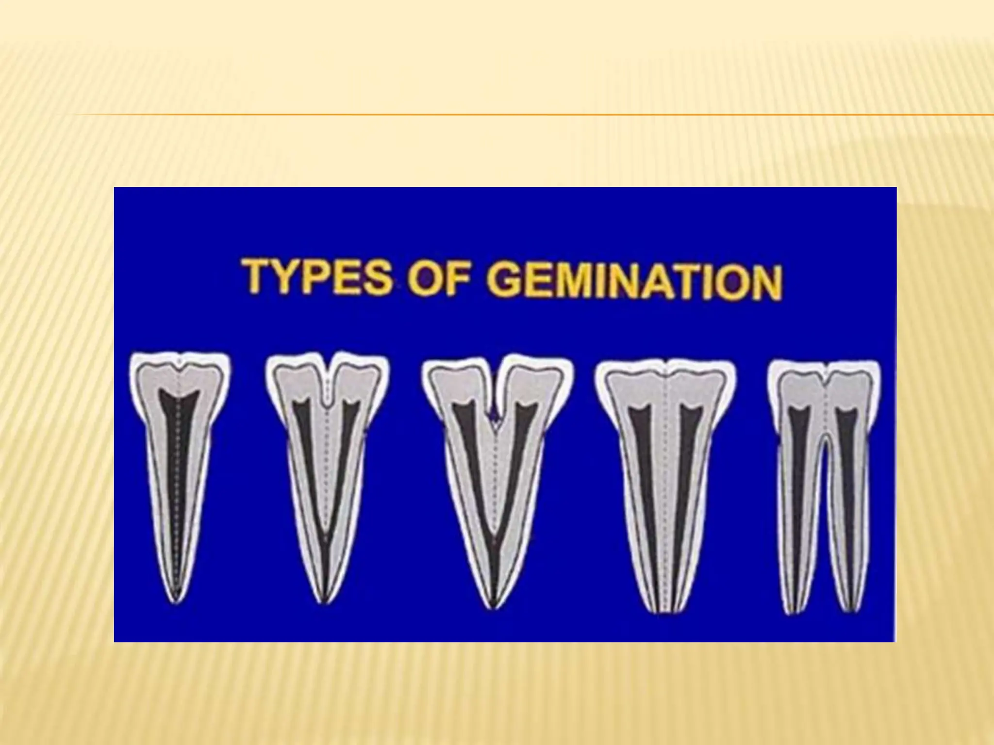 CONGENITAL AND DEVELOPMENTAL DEFECTS OF TEETH.pptx