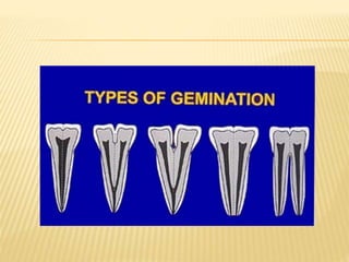 CONGENITAL AND DEVELOPMENTAL DEFECTS OF TEETH.pptx