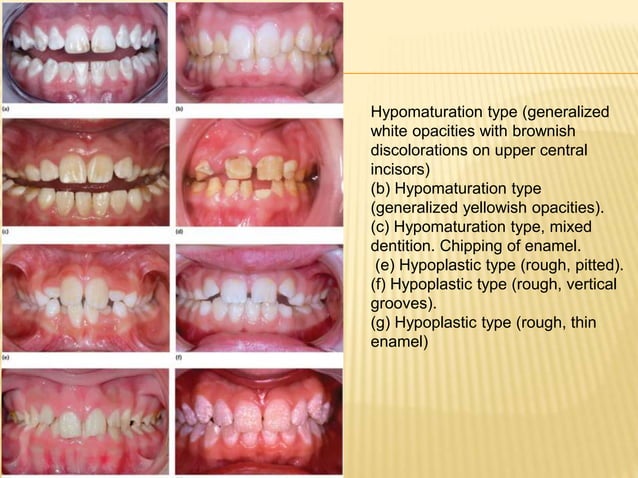 CONGENITAL AND DEVELOPMENTAL DEFECTS OF TEETH.pptx