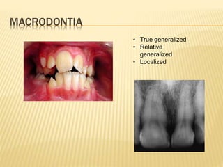 CONGENITAL AND DEVELOPMENTAL DEFECTS OF TEETH.pptx