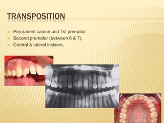 CONGENITAL AND DEVELOPMENTAL DEFECTS OF TEETH.pptx