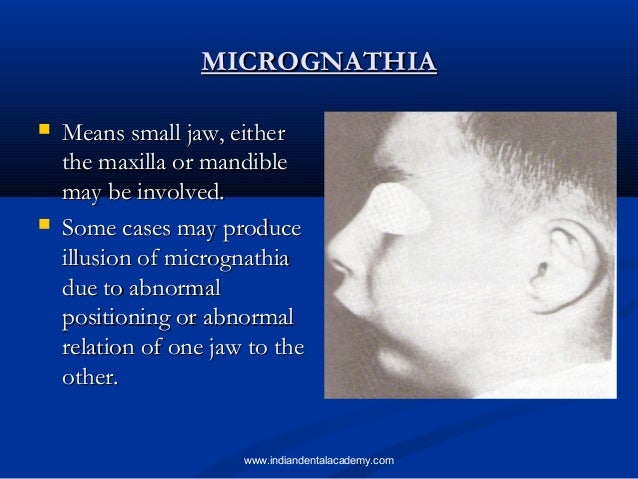 Congenital and developmental disorders of mandible