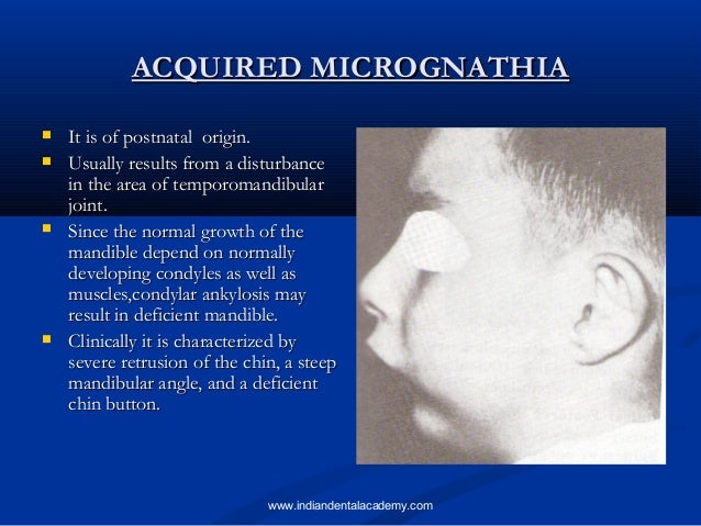 Congenital and developmental disorders of mandible