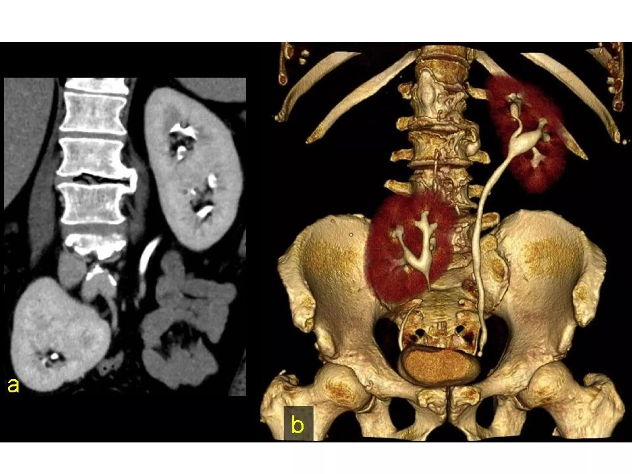 Diagnostic Imaging of Congenital Renal Anomalies | PPT
