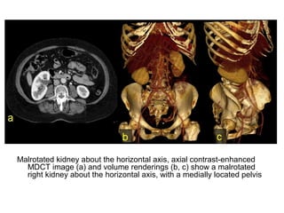 Diagnostic Imaging of Congenital Renal Anomalies | PPT