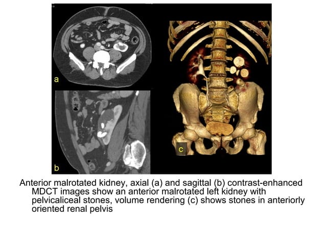 Diagnostic Imaging of Congenital Renal Anomalies | PPT | Medical Health