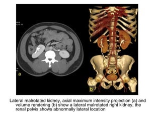 Diagnostic Imaging of Congenital Renal Anomalies | PPT