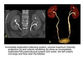 Diagnostic Imaging of Congenital Renal Anomalies | PPT