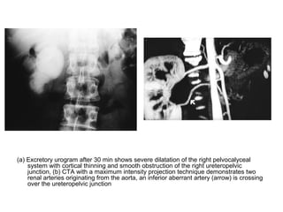 Diagnostic Imaging of Congenital Renal Anomalies | PPT