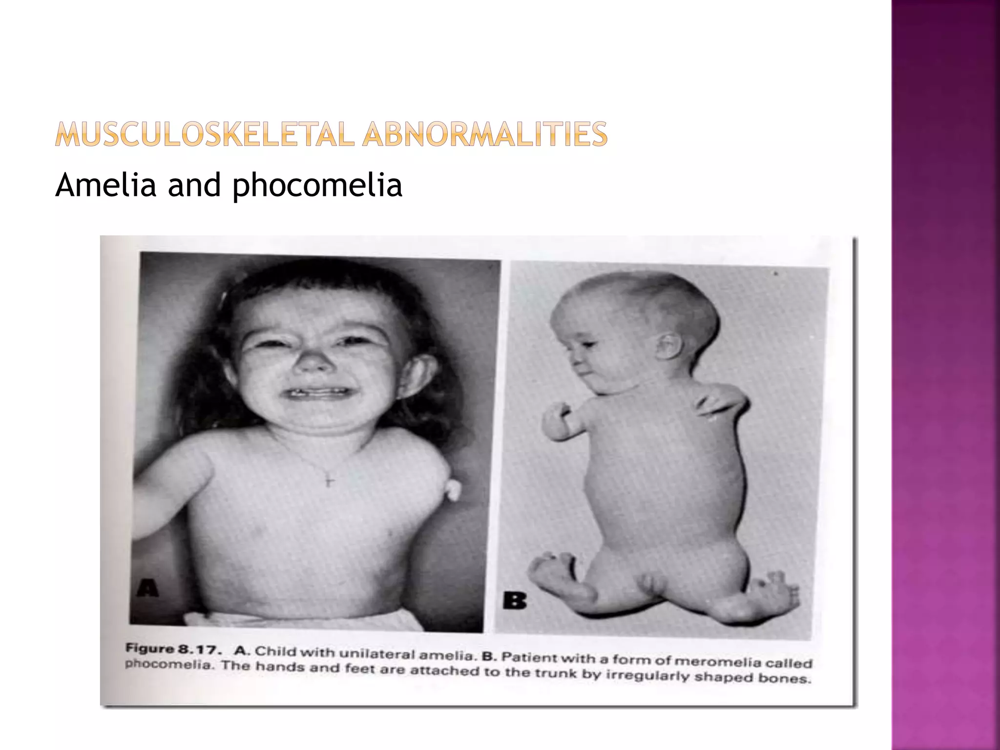 Congenital anomalies | PPTX
