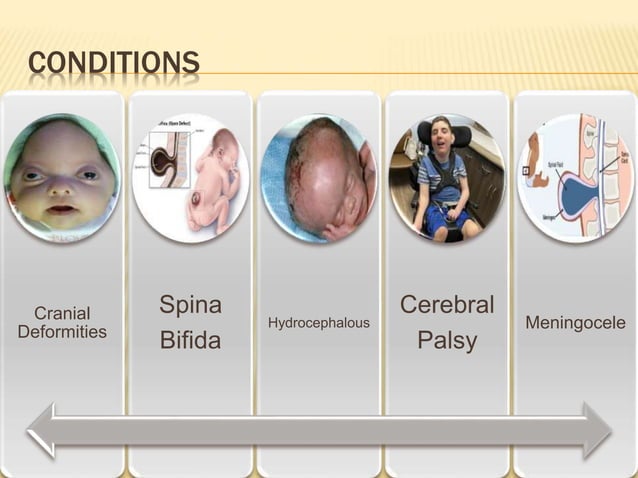 Congenital anomalies/Neural tube defects/ birth defects | PPT