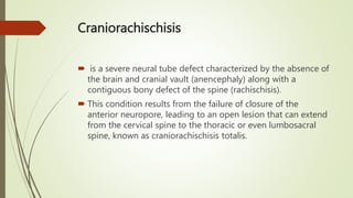 Congenital Anomalies of nervoussystem.pptx