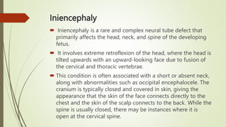 Congenital Anomalies of nervoussystem.pptx