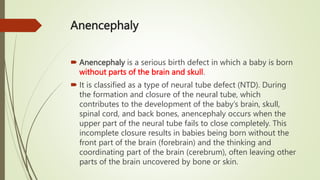 Congenital Anomalies of nervoussystem.pptx