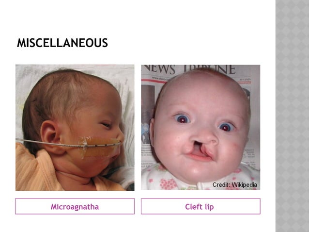Common congenital anomalies by Dr Amber Mushtaq | PPTX | Pregnancy ...
