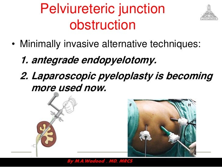 Upj Obstruction Causes Symptoms Treatment Upj Obstruction
