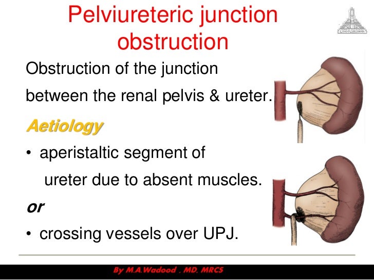 Upj Obstruction Causes Symptoms Treatment Upj Obstruction