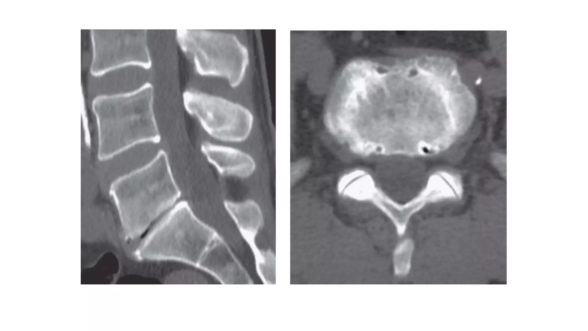 Congenital anomalies and degenerative conditions of vertebra | PPTX