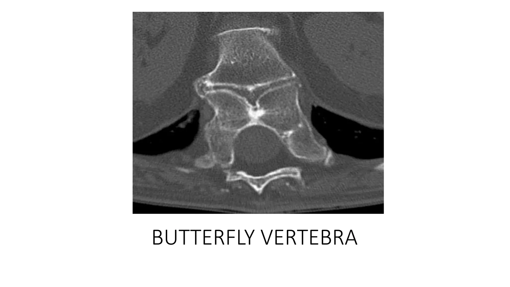 Congenital anomalies and degenerative conditions of vertebra | PPTX