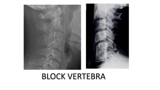 Congenital anomalies and degenerative conditions of vertebra | PPTX