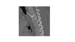 Congenital anomalies and degenerative conditions of vertebra | PPTX