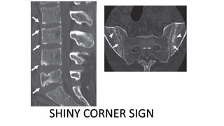 Congenital anomalies and degenerative conditions of vertebra | PPTX