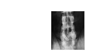Congenital anomalies and degenerative conditions of vertebra | PPTX