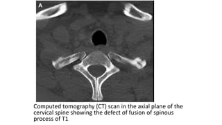 Congenital anomalies and degenerative conditions of vertebra | PPTX