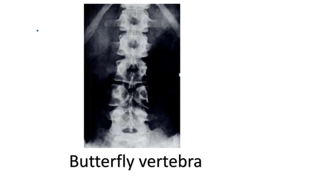 Congenital anomalies and degenerative conditions of vertebra | PPTX ...