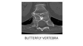 Congenital anomalies and degenerative conditions of vertebra | PPTX