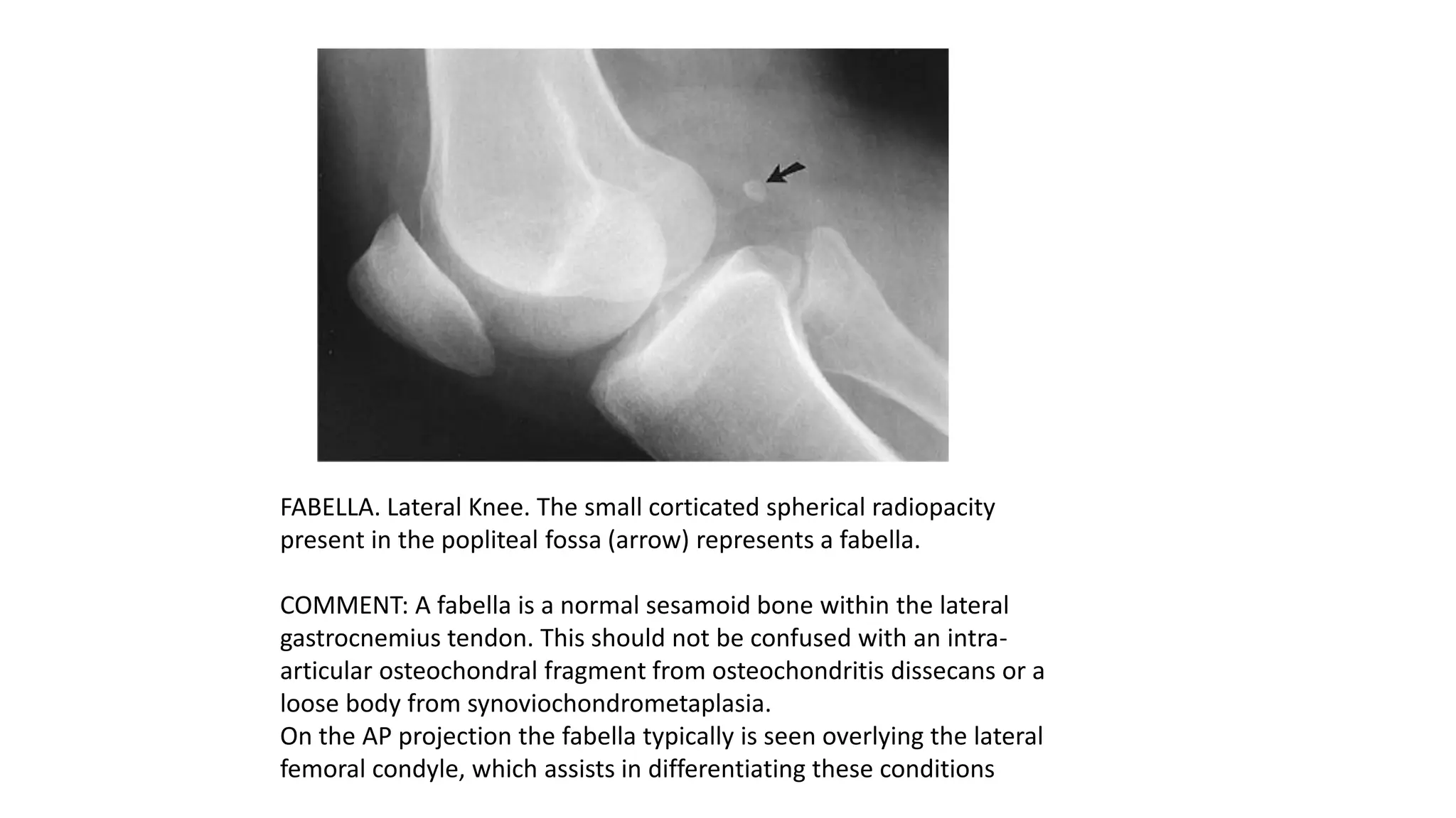CONGENITAL ANOMALIES ANDNORMAL SKELETAL VARIENTS.pptx a.pptx final ppt.pptx
