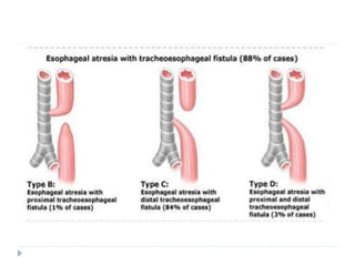 Esophagus - Congenital anomalies, inflammatory & neoplastic disorders ...
