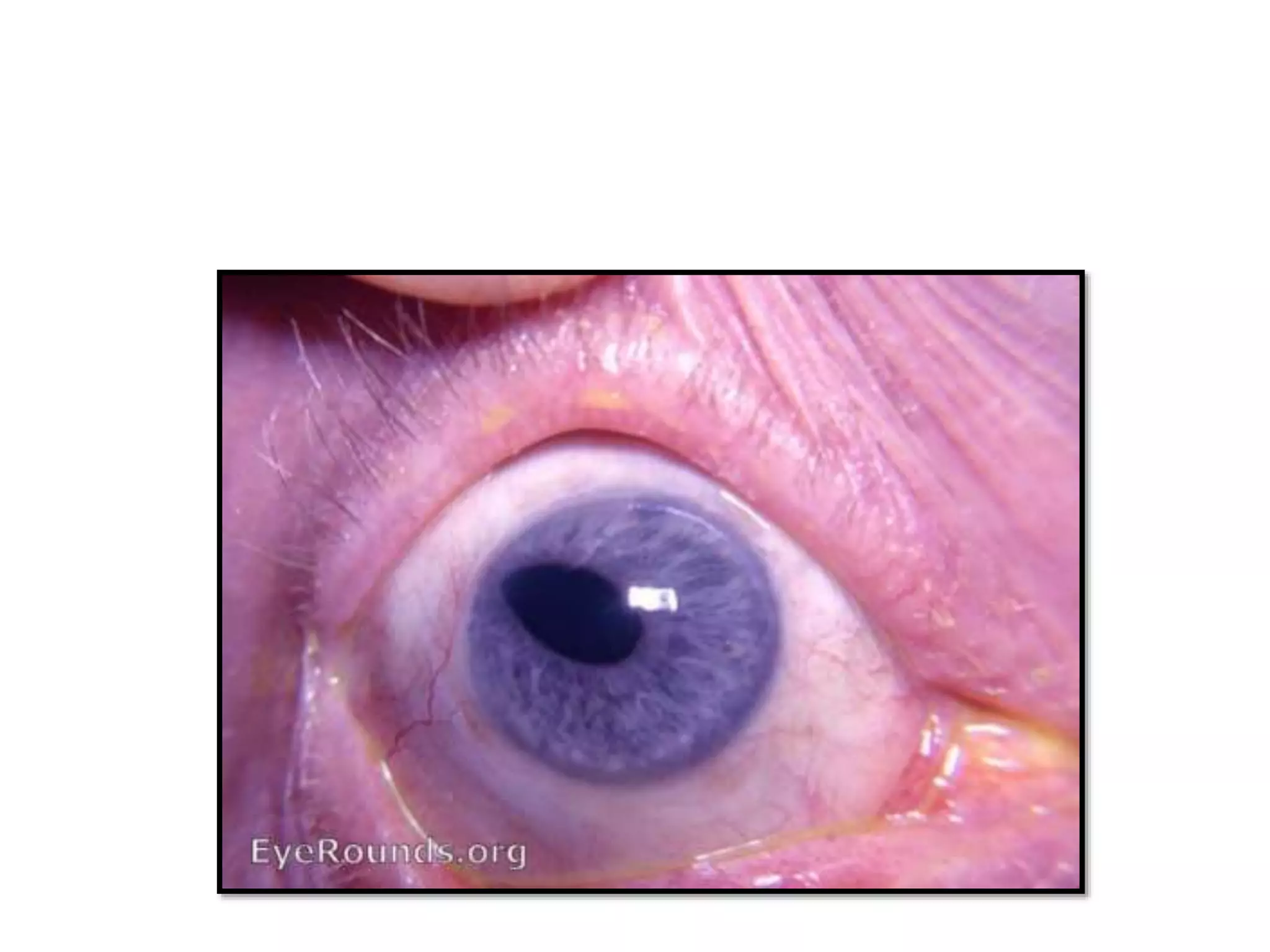 Congenital anomalies in the eye | PPTX