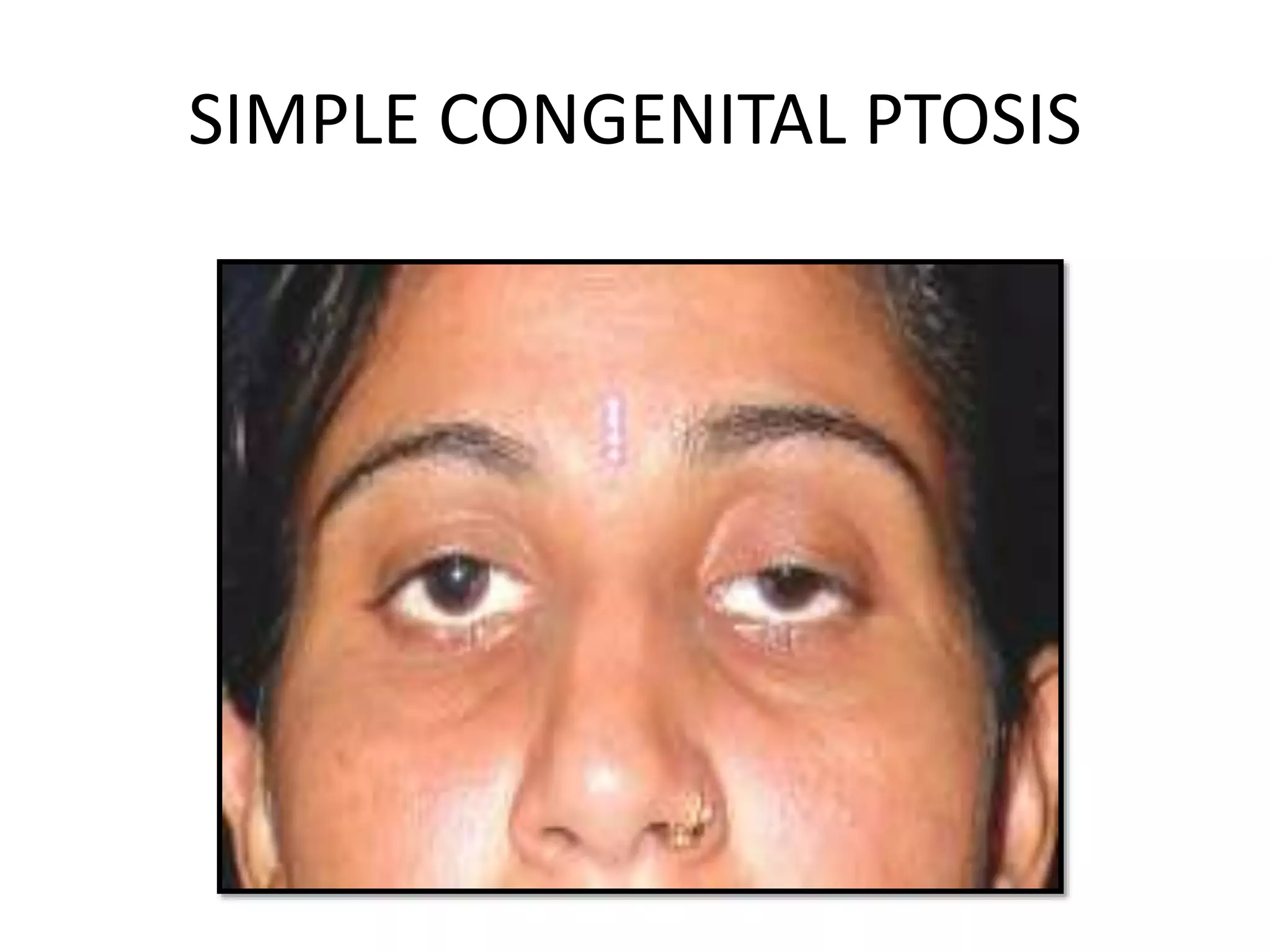 Congenital anomalies in the eye | PPTX