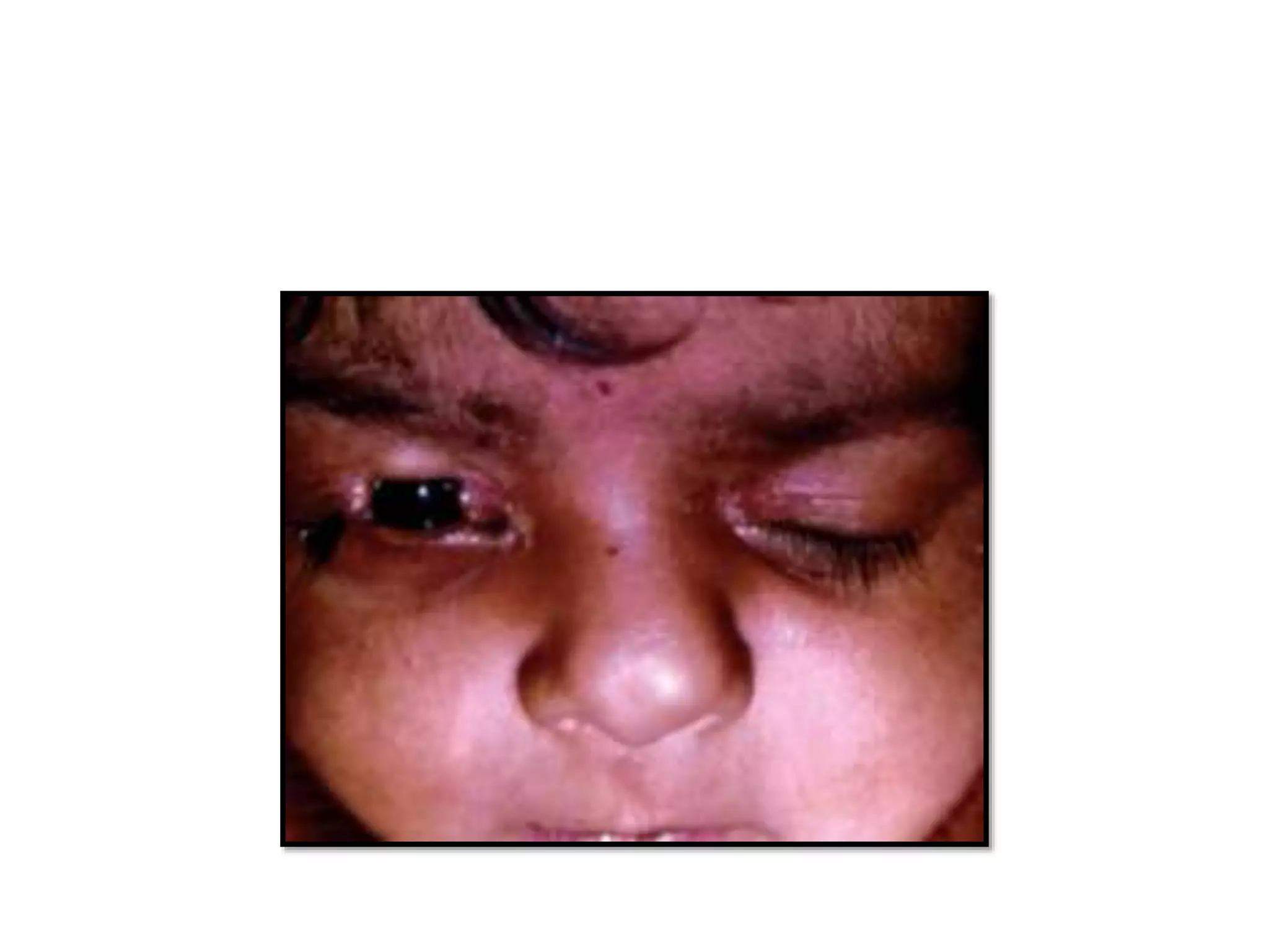Congenital anomalies in the eye | PPTX