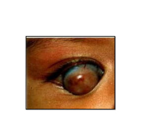 Congenital anomalies in the eye | PPTX
