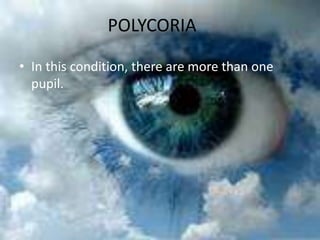 Congenital anomalies in the eye | PPTX