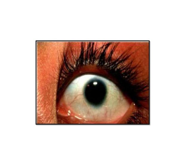 Congenital anomalies in the eye