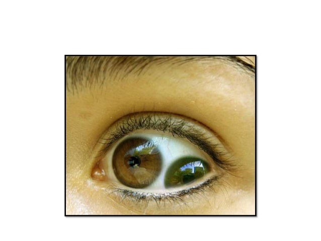 Congenital anomalies in the eye