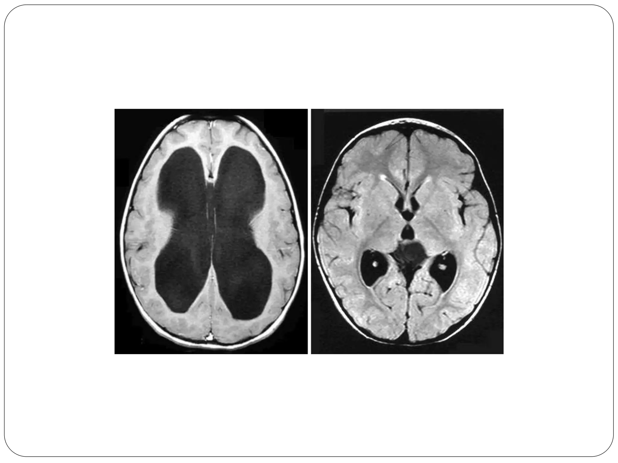 congenital_anomalies of central nervous system | PPTX