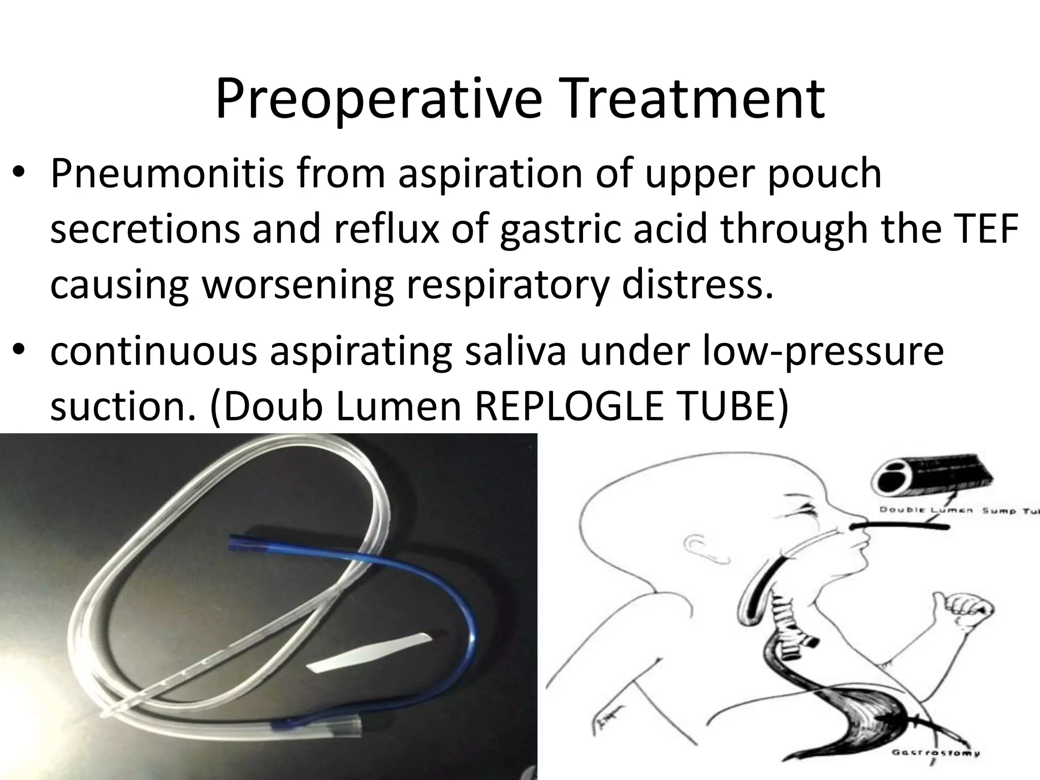 PRANAYA PPT - TRACHEOESOPAHAGEAL FISTULA ( EA-TEF ) | PPTX