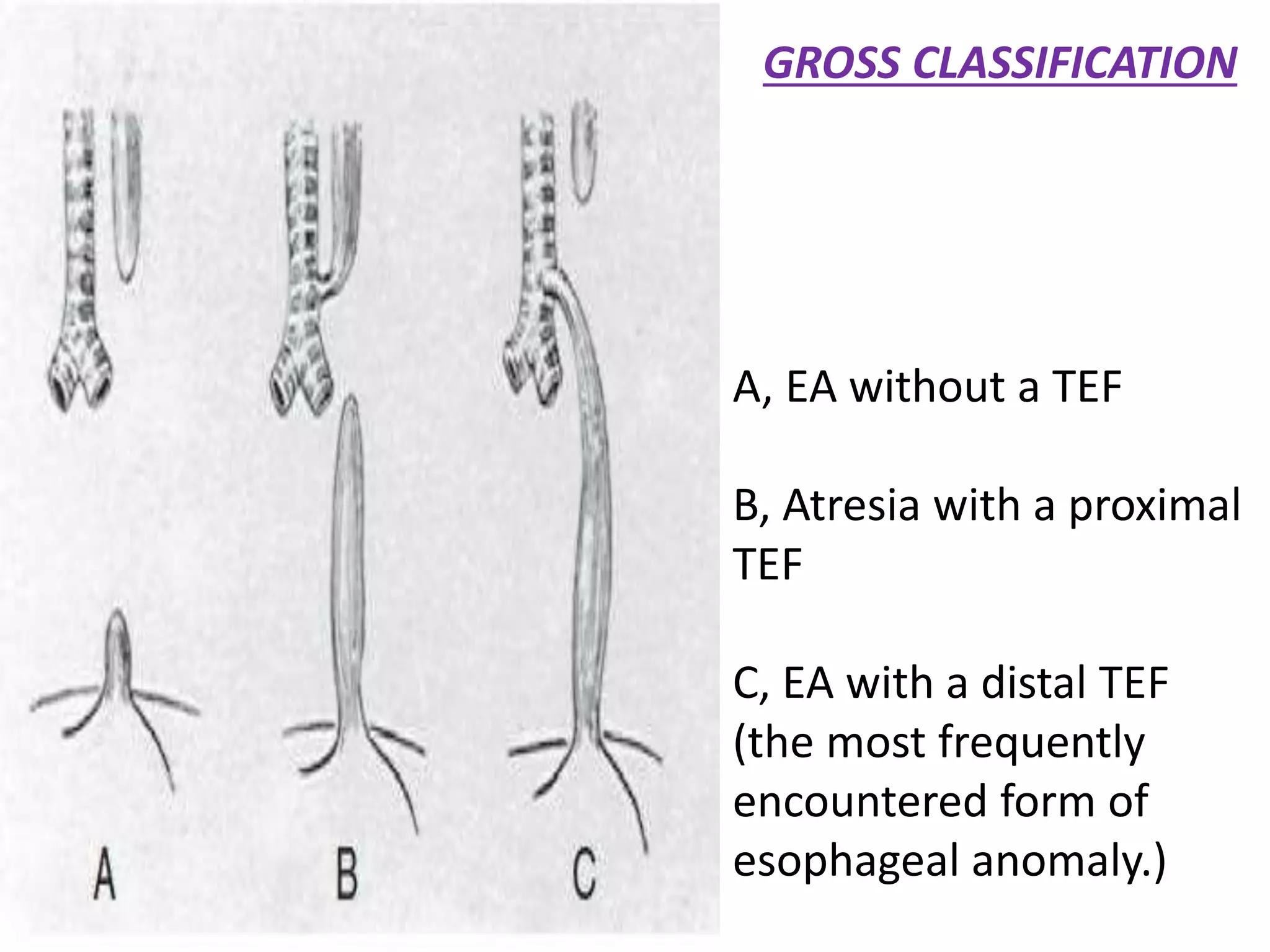 PRANAYA PPT - TRACHEOESOPAHAGEAL FISTULA ( EA-TEF ) | PPTX