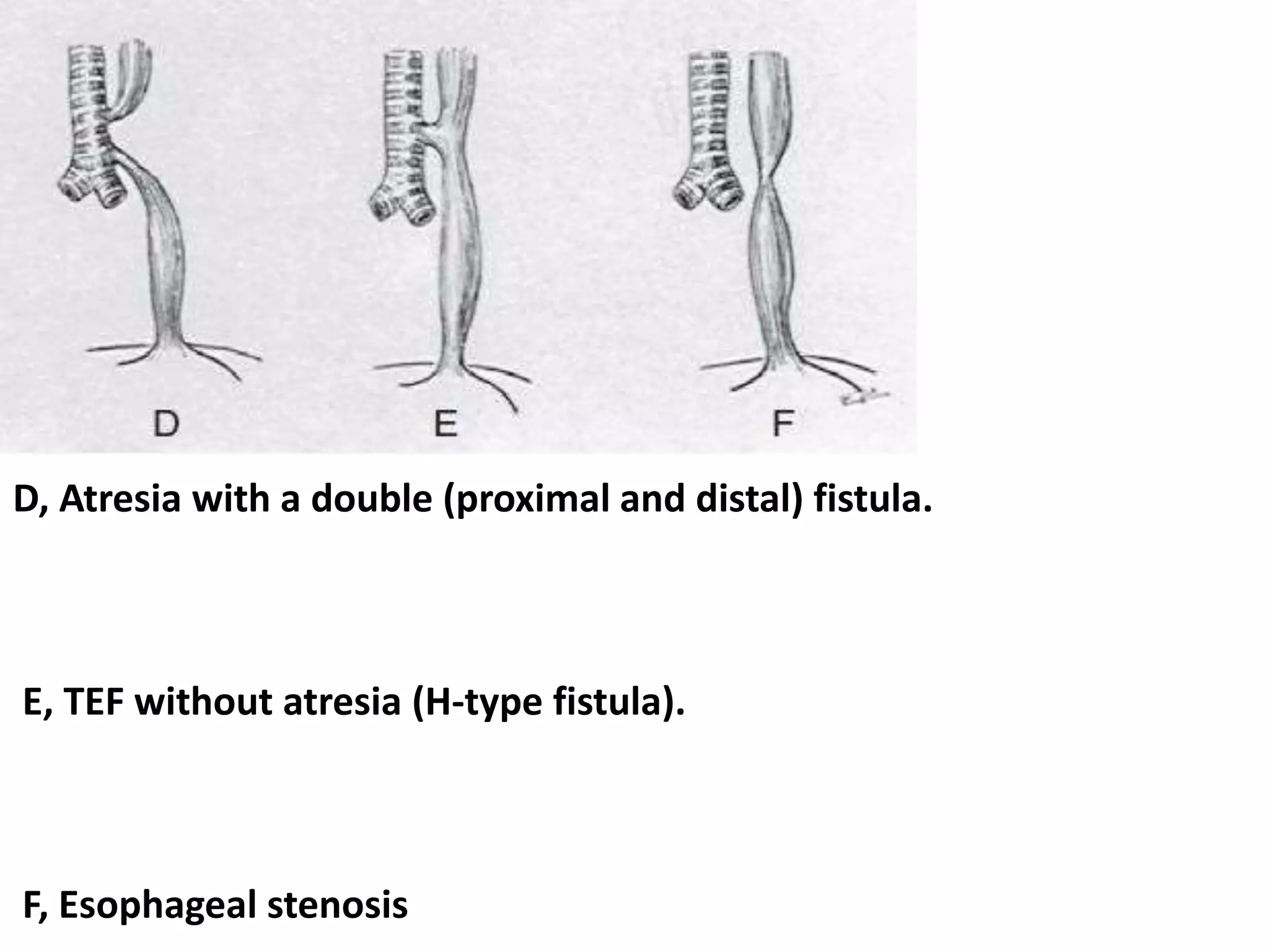 PRANAYA PPT - TRACHEOESOPAHAGEAL FISTULA ( EA-TEF ) | PPTX