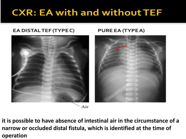 PRANAYA PPT - TRACHEOESOPAHAGEAL FISTULA ( EA-TEF ) | PPT